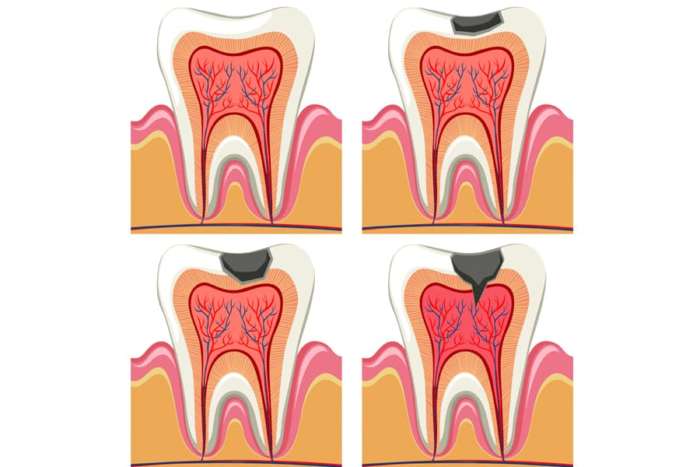 Dientes podridos ¿Cuáles son sus causas y tratamientos?