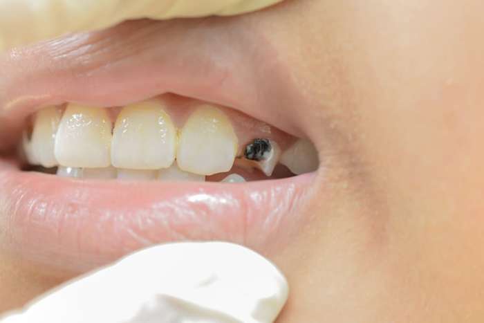 Pulpitis ¿Qué es y cómo se cura esta patología dental?