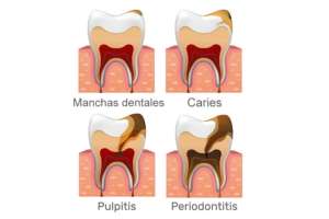 Pulpitis ¿Qué es y cómo se cura esta patología dental?