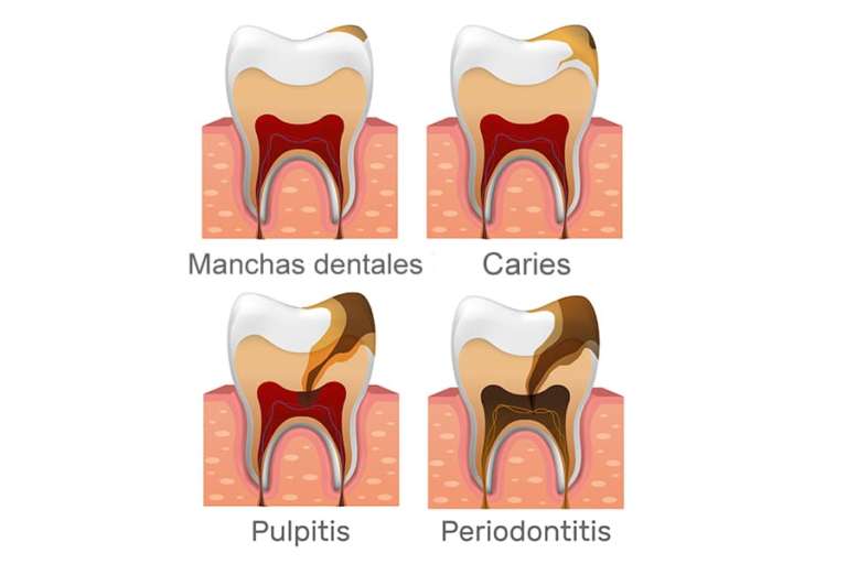 Pulpitis ¿Qué es y cómo se cura esta patología dental?