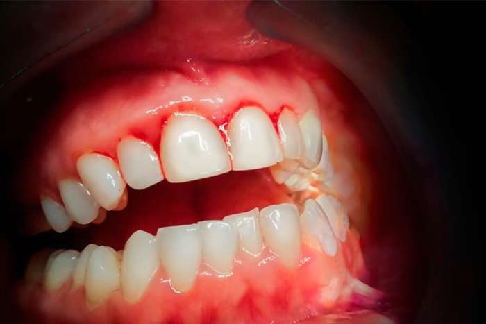 12 enfermedades de la boca más comunes | Clínicas Den