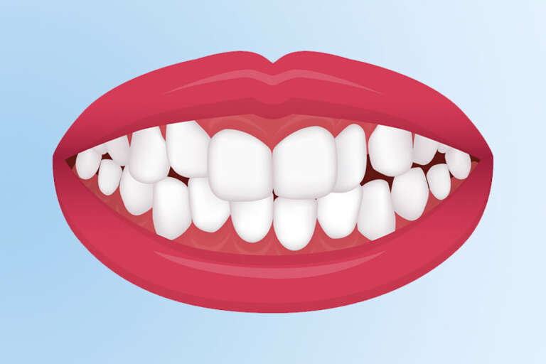 Maloclusión dental ¿Qué es y cómo corregirla?