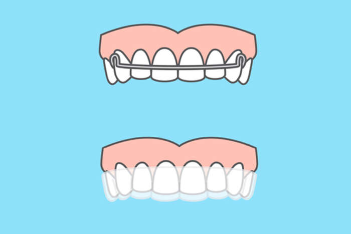 Retenedor dental de ortodoncia ¿Para qué sirve?