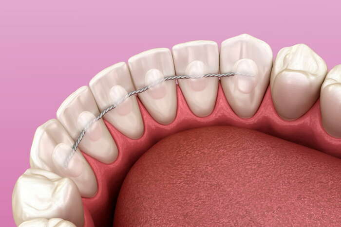 Retenedor dental de ortodoncia ¿Para qué sirve?