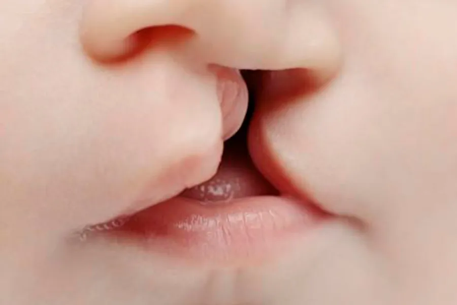 Ecografía De Labio Hendido Bilateral