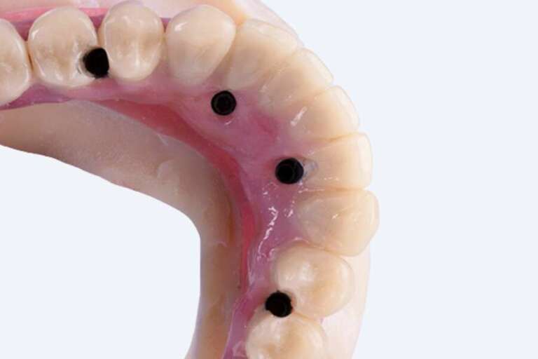¿Qué es la anodoncia? Causas + tratamientos