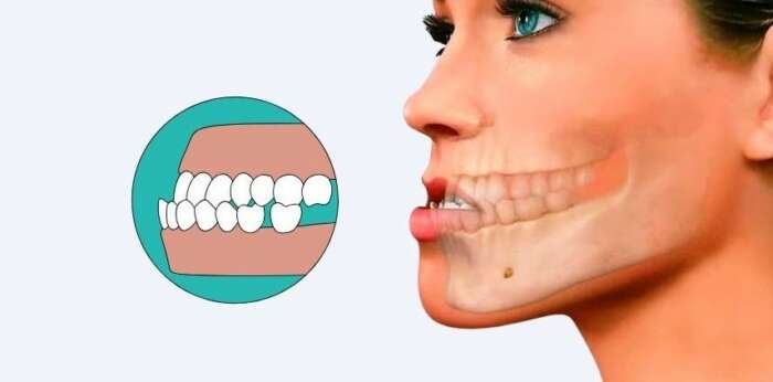 Prognatismo mandibular o Clase 3 ¿qué es y cómo se corrige?
